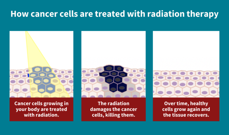 What is Radiation Therapy? – Stanford Med Education